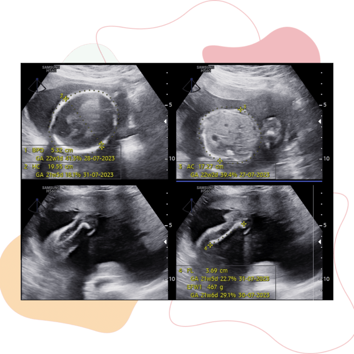 Biaya USG Fetomaternal: Panduan Lengkap Untuk Ibu Hamil - PULUNG.NET